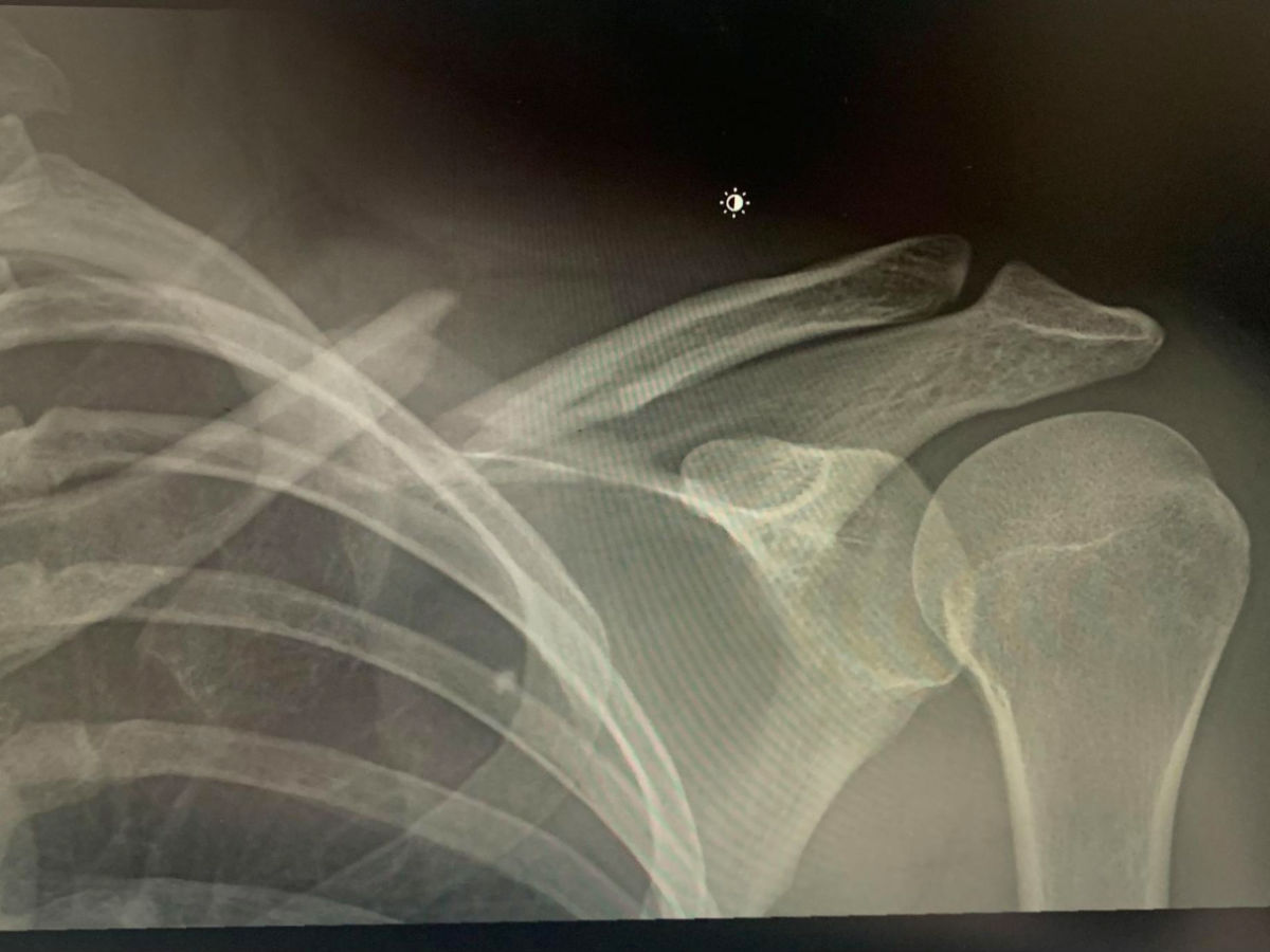 The story of how I broke my collarbone traveling in Italy